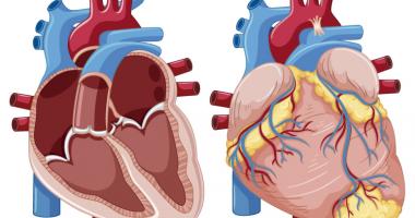 ACV hemorrágico: cómo reconocer el ictus hemorrágico - Bupa