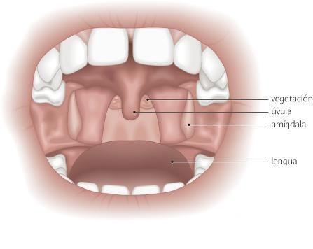 Adenoamigdalectomía: extracción de amígdalas y adenoides